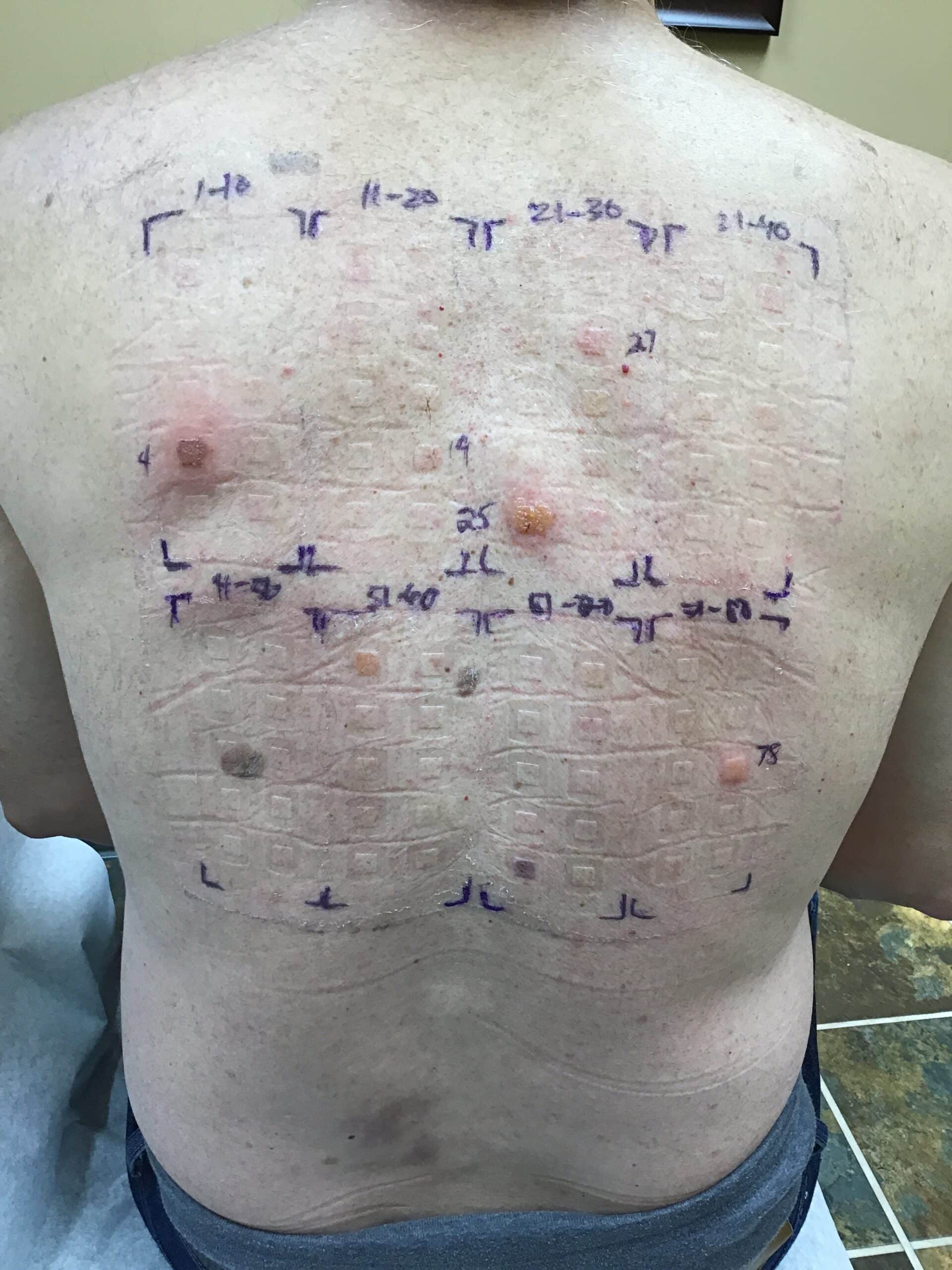 Allergic Contact Dermatitis Treatment | Dermatology Associates ...